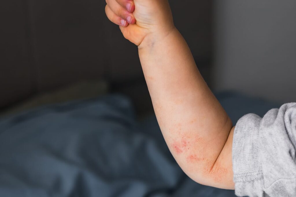 Eczema - Dermatology Associates Skin & Cancer