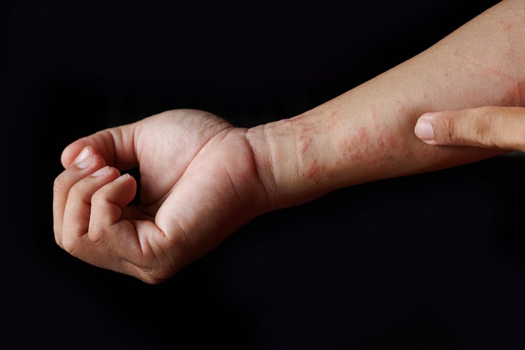 Fungal Infections | Dermatology Associates Skin & Cancer