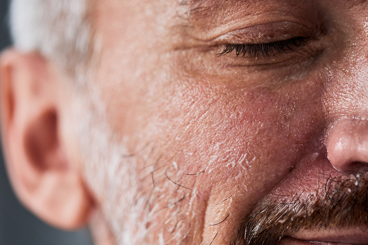 Lumecca Intense Pulsed Light (IPL) | Dermatology Associates Skin & Cancer