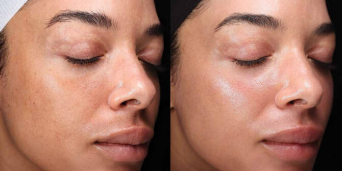 HALO® TRIBRID™ | Dermatology Associates Skin & Cancer